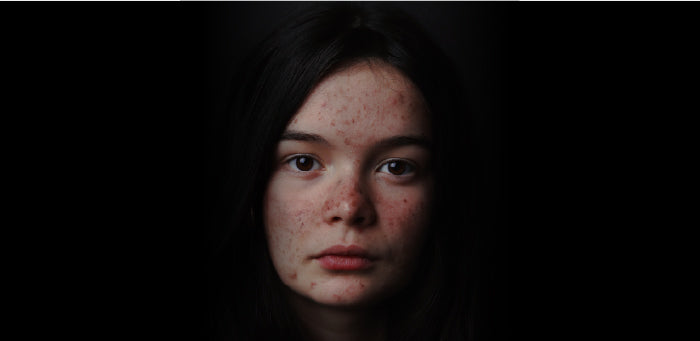 LIGHT THERAPY AND ACNE: THESE WAVELENGTHS WILL GET YOU THE FASTEST RES ...