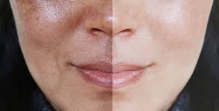 Red Light Therapy and Hyperpigmentation - Can it fade dark spots ...